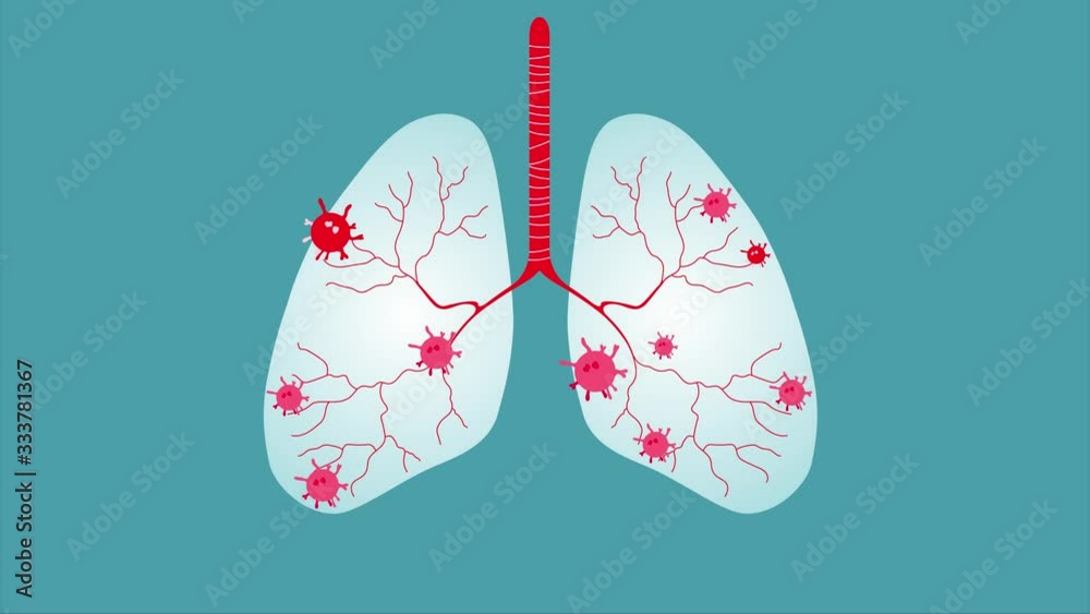 Coronavirus bacterias in lungs. 4K animated illustration loop. Big ...