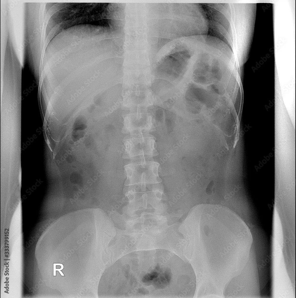 Intravenous pyelogram. Supine position. Intestinal gas partially ...