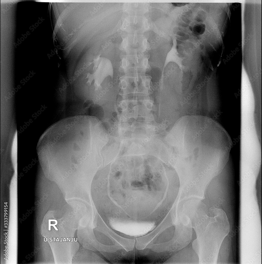 Intravenous urogram (IVU). Erect position. Ureters are without signs of ...