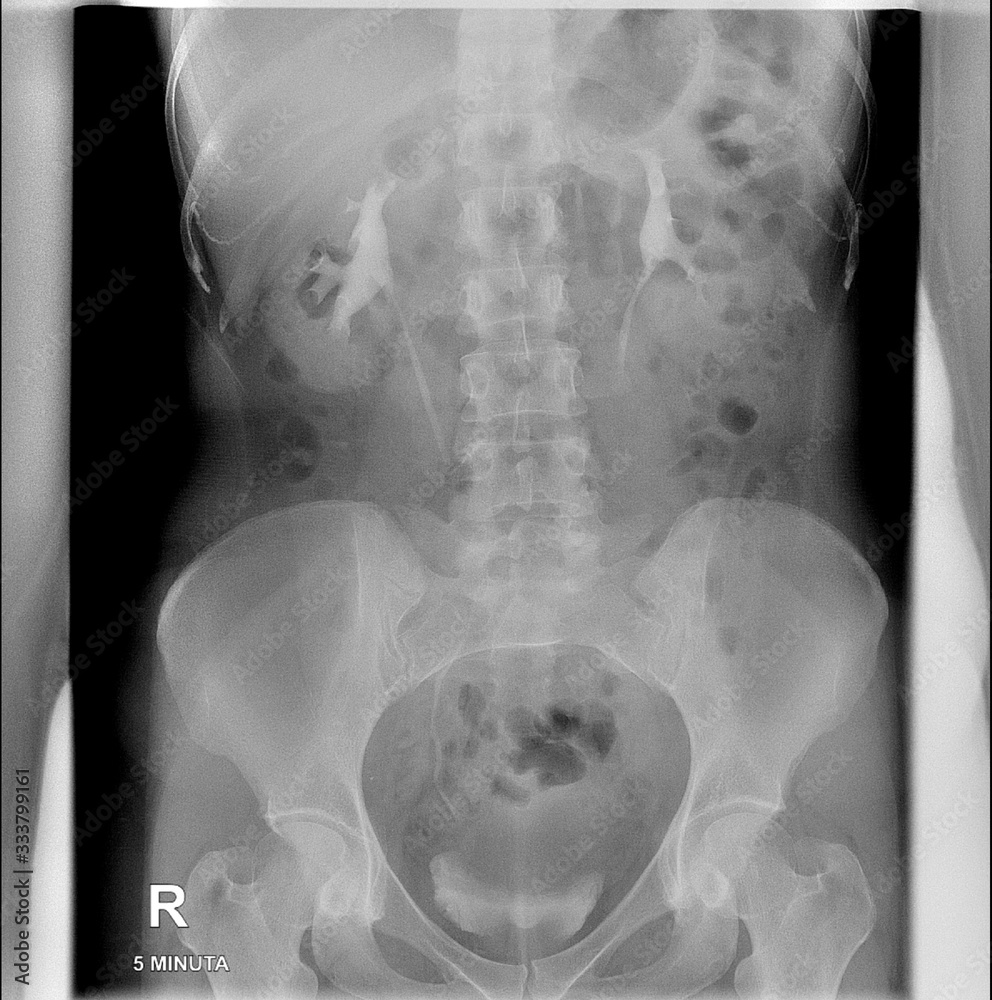 RTG Intravenous pyelogram (IVP) or intravenous urogram (IVU). Supine ...