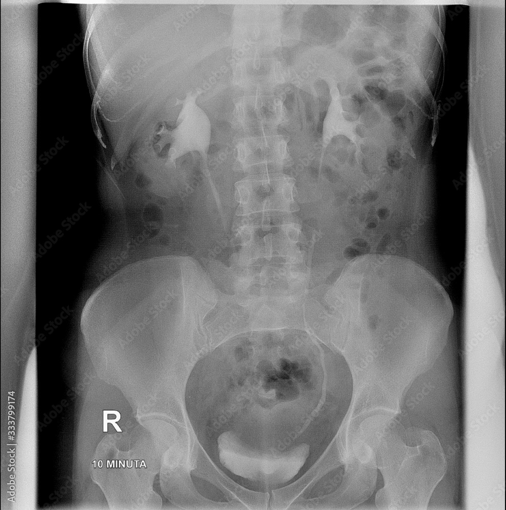 IVU. Intravenous urogram. Supine position. Ureters are without signs of ...