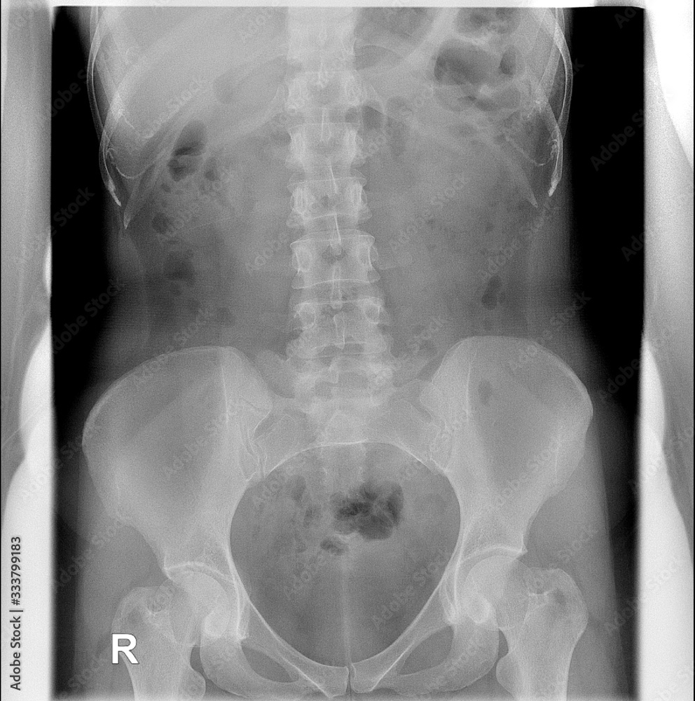 Intravenous pyelogram (IVP). Supine position. Both kidney shadows ...