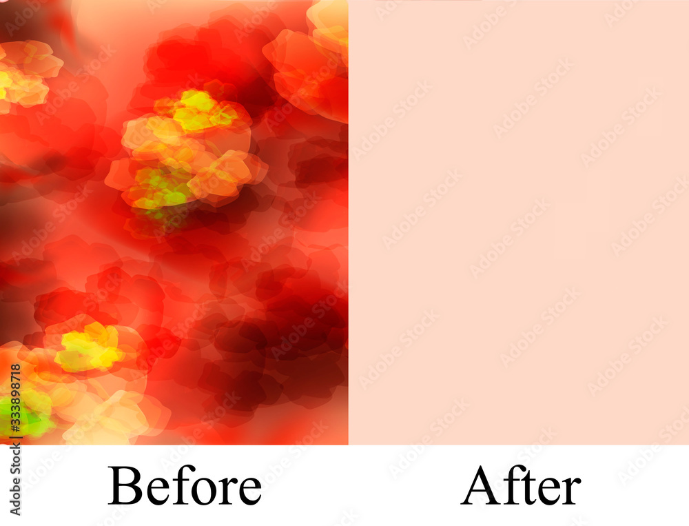Vecteur Stock Texture, inflamed pimples and acne. Before After acne ...