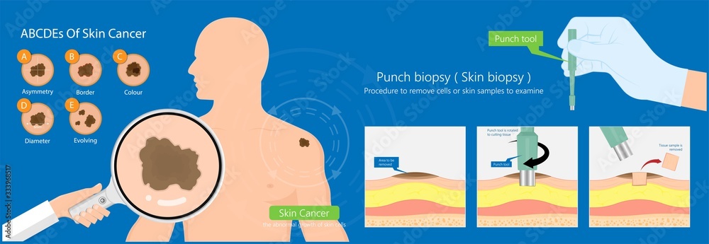 Skin Biopsy Dermoscope Tool Surgical Diagnose Lupus Rash Cell Exam