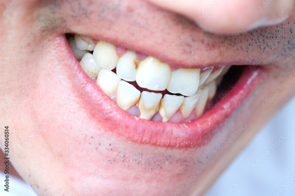 Tooth's a man smoking bad. Man smokes a cigarettes have tooth decay and ...