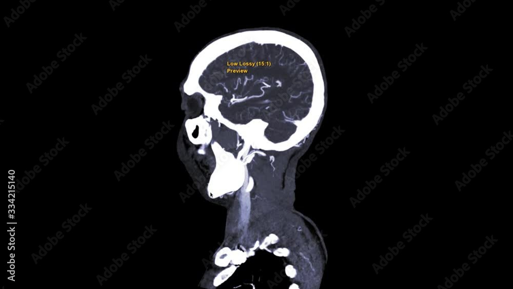 CTA Brain or computed tomography angiography of the brain sagittal mip ...