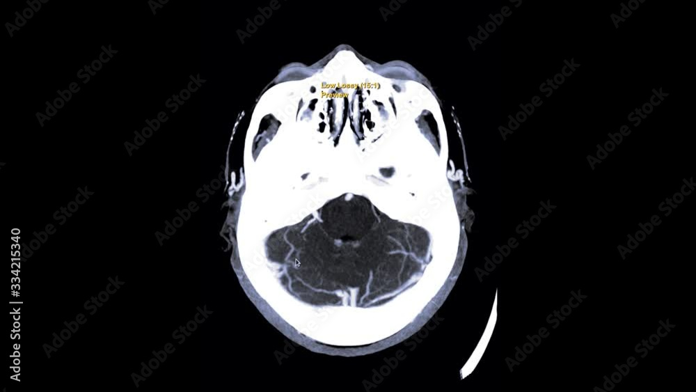 CTA Brain or computed tomography angiography of the brain axial mip ...