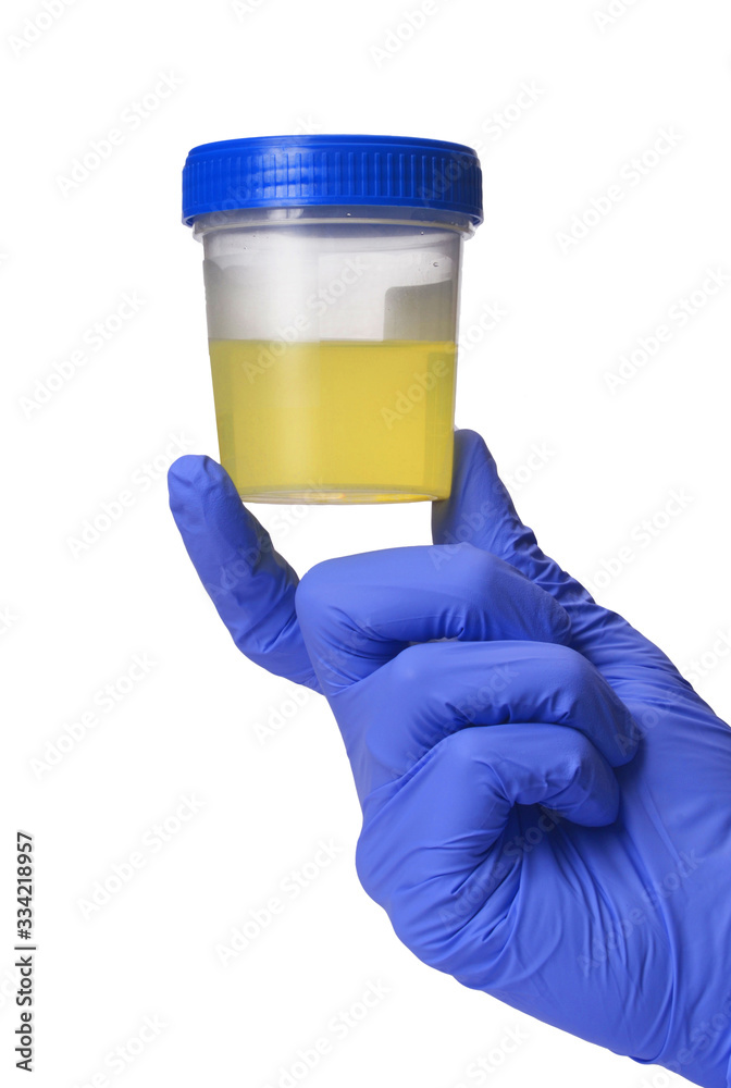 Urine specimen: medical analysis. Urine analysis in the laboratory ...