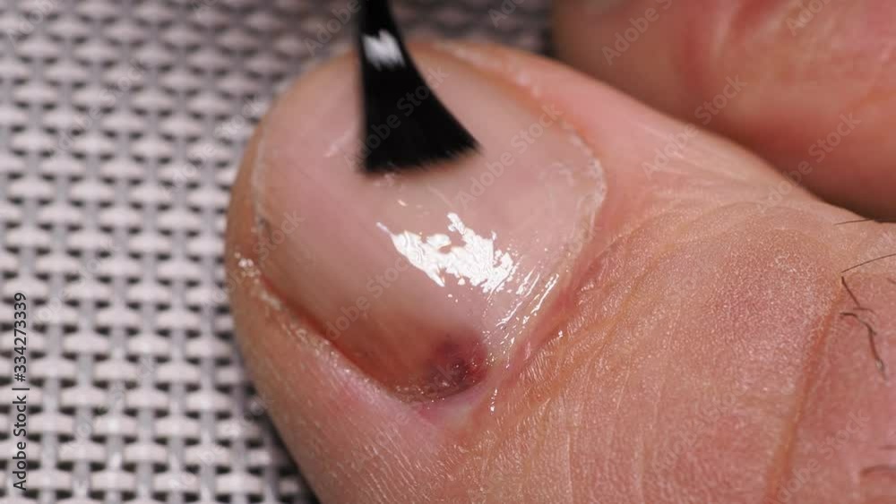 Application of nail solution with brush. Nail infections caused by ...