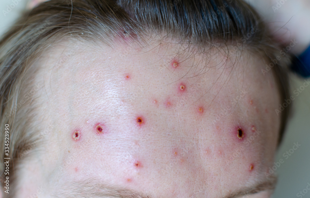 Foto de Large spots and pimples acne on the body - adult body with ...