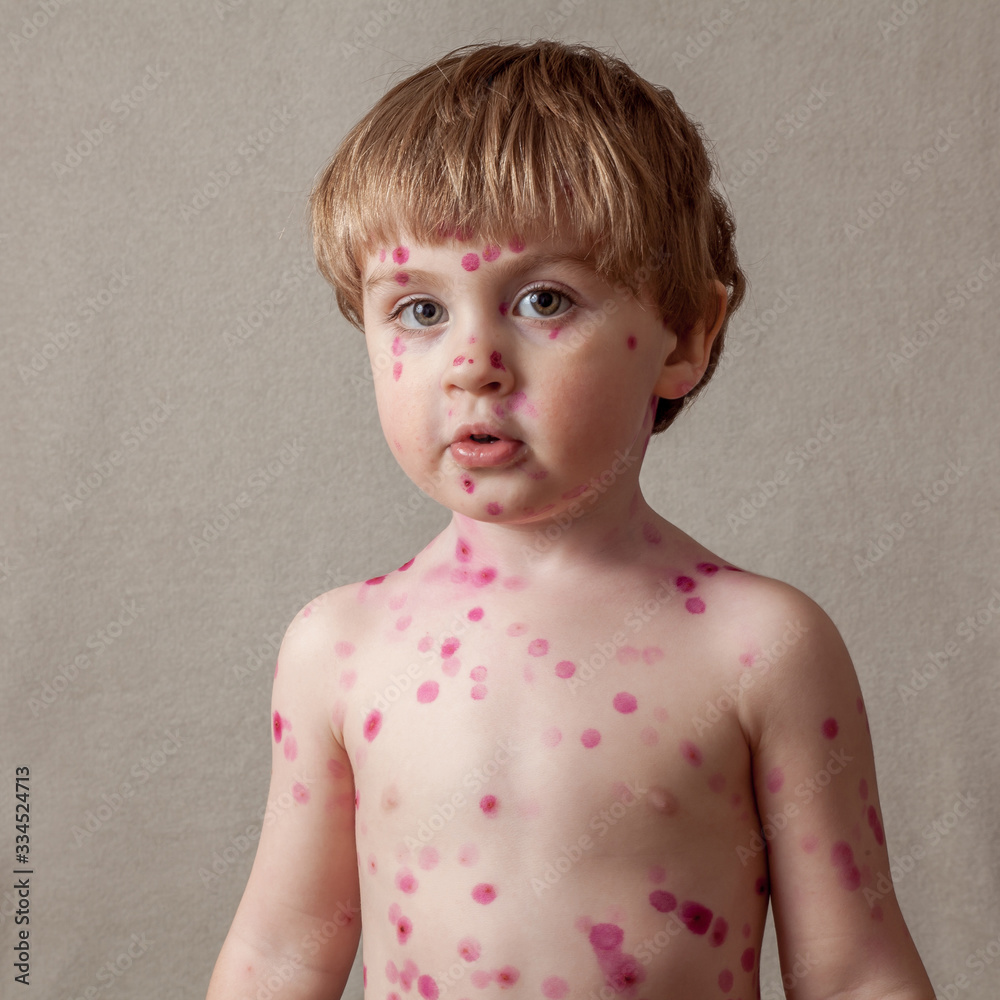 ,boy with chickenpox. Sick child with chickenpox. Varicella virus or ...