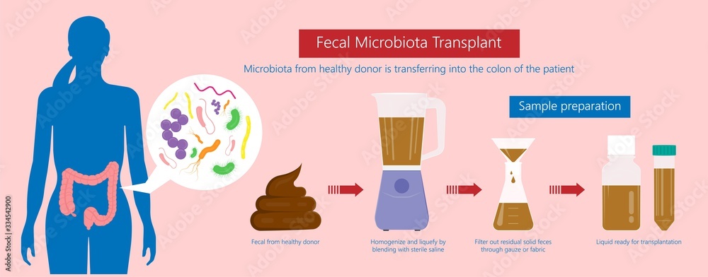 Fecal microbiota transplant (FMT) stool transferring bacteria microbes ...