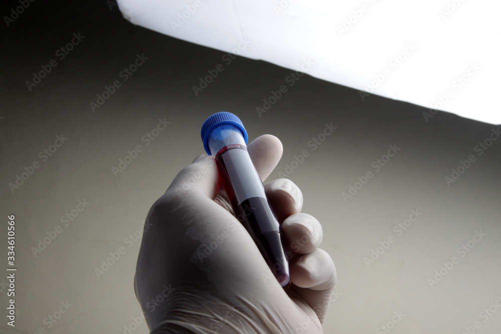Blood sample from patient placed into test tube for analyzing and ...
