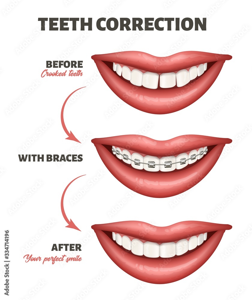 Medical poster showing a teeth correction process. Vector illustration ...