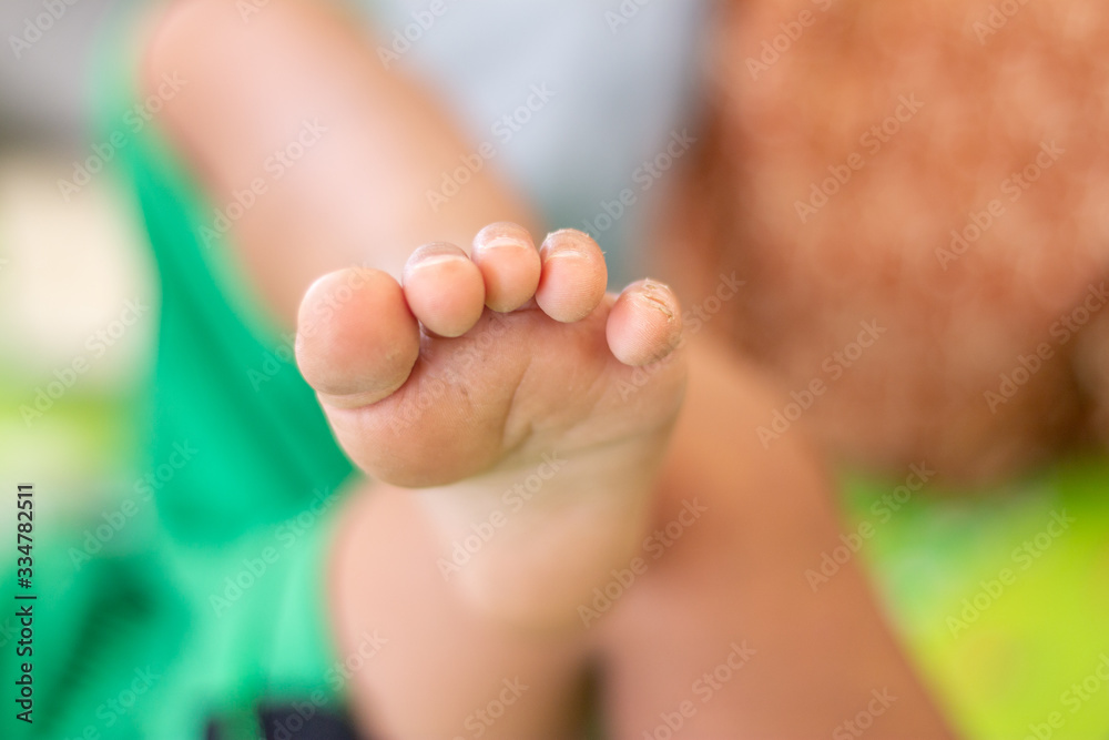 Baby Feet And Toes Have Scars On The Toes Stock Photo Adobe Stock baby-feet-and-toes-have-scars-on-the-toes-stock-photo-adobe-stock