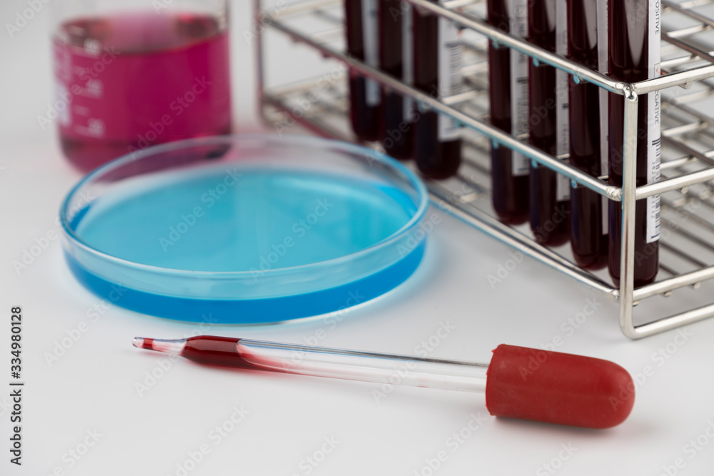 Methylene blue test liquid with blood sample for test, laboratory ...