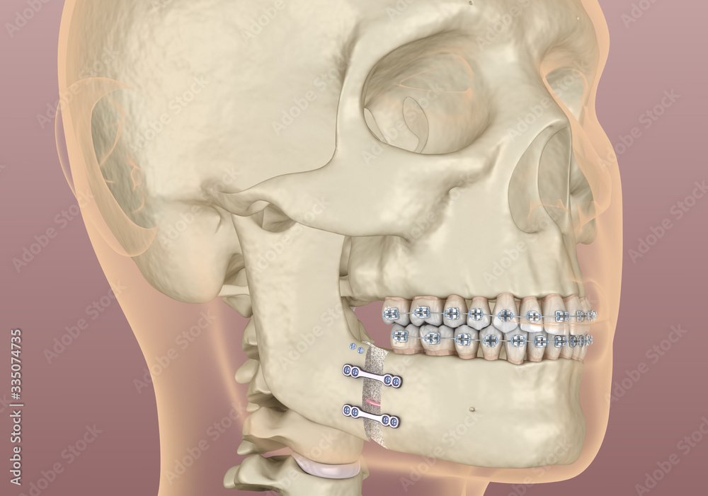 Mandibular Advancement surgery. Medically accurate dental 3D ...