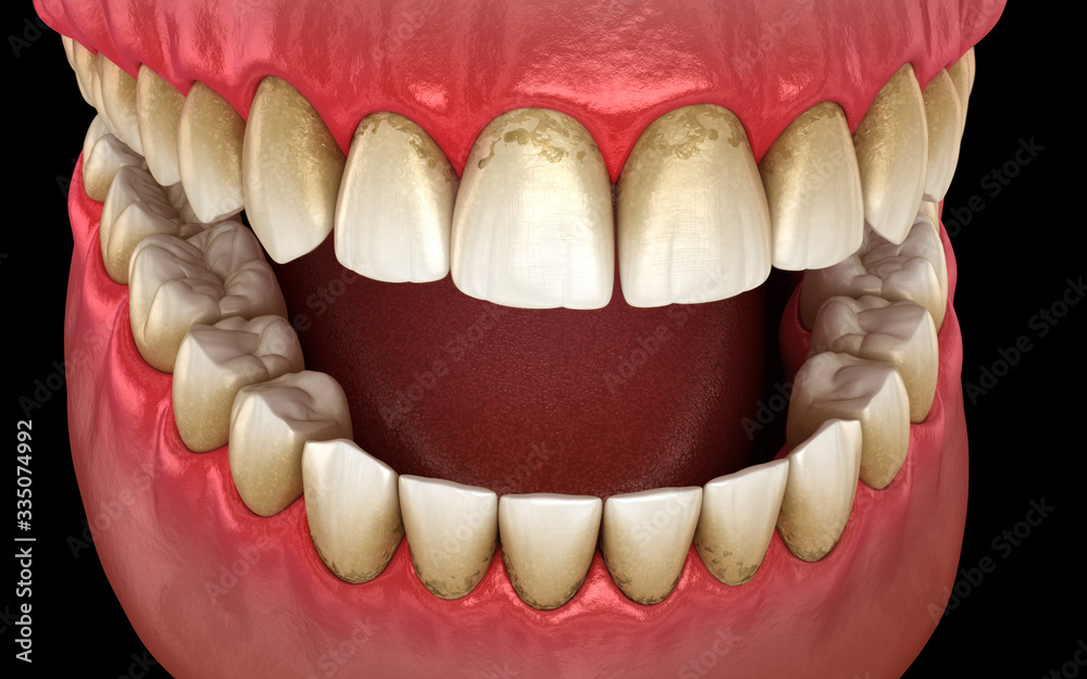 Tartar and bactrail tooth plaque, jaw inflammation. Medically accurate ...
