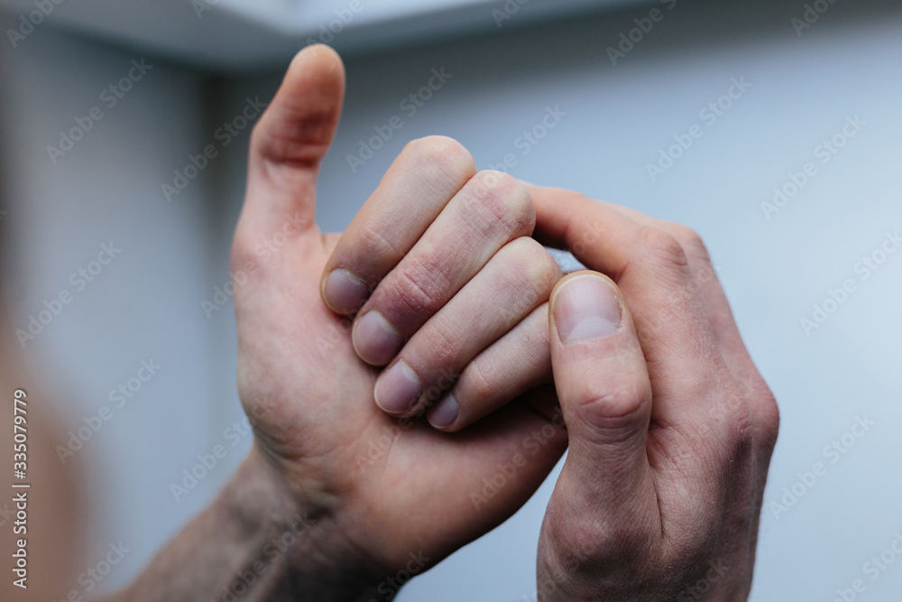 Man with sick hands, dry flaky skin on his hand with vulgar psoriasis ...