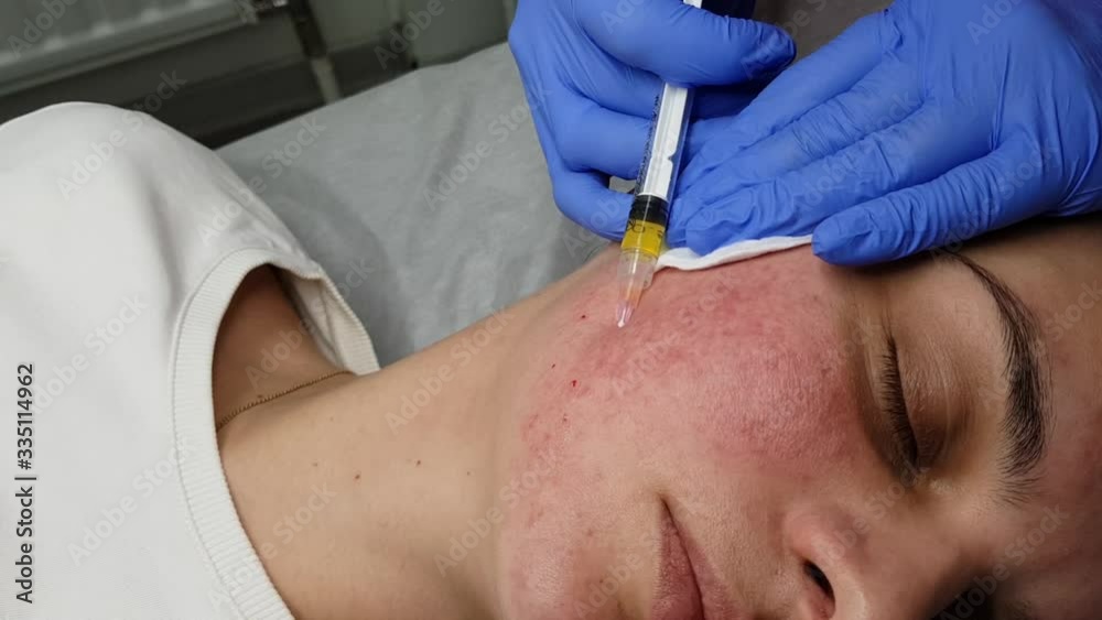 Procedure of plasmolifting to young woman at cosmetology clinic ...