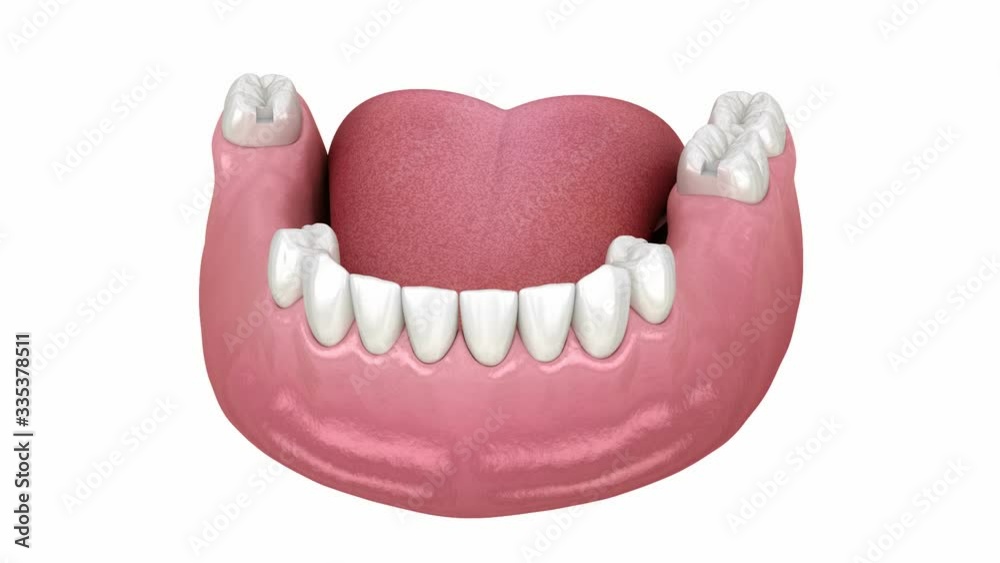 Removable partial denture, mandibular prosthesis. Medically accurate 3D ...