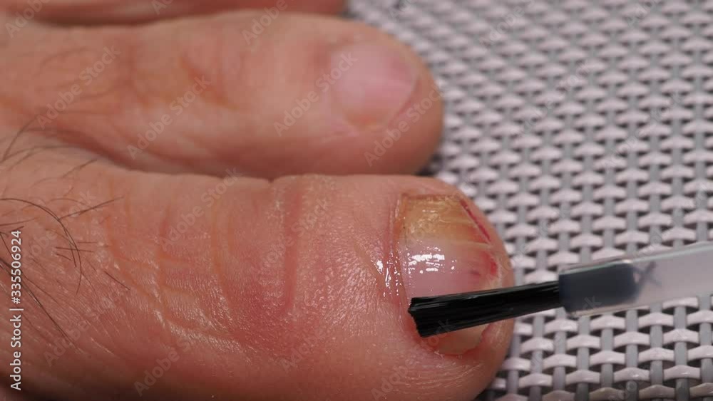 Application of nail solution with brush. Nail infections caused by ...