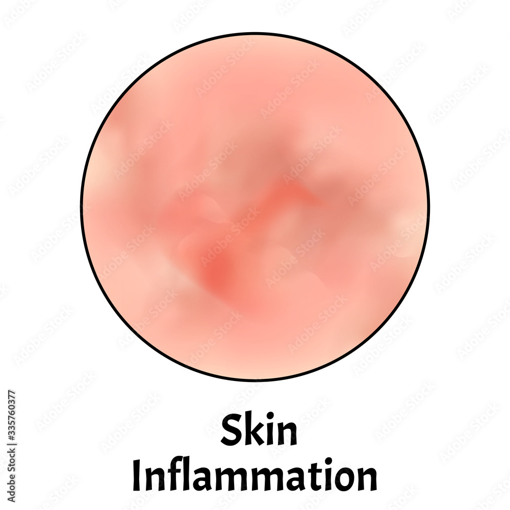 Skin inflammation. Dermatitis skin. Infographics. Vector illustration ...