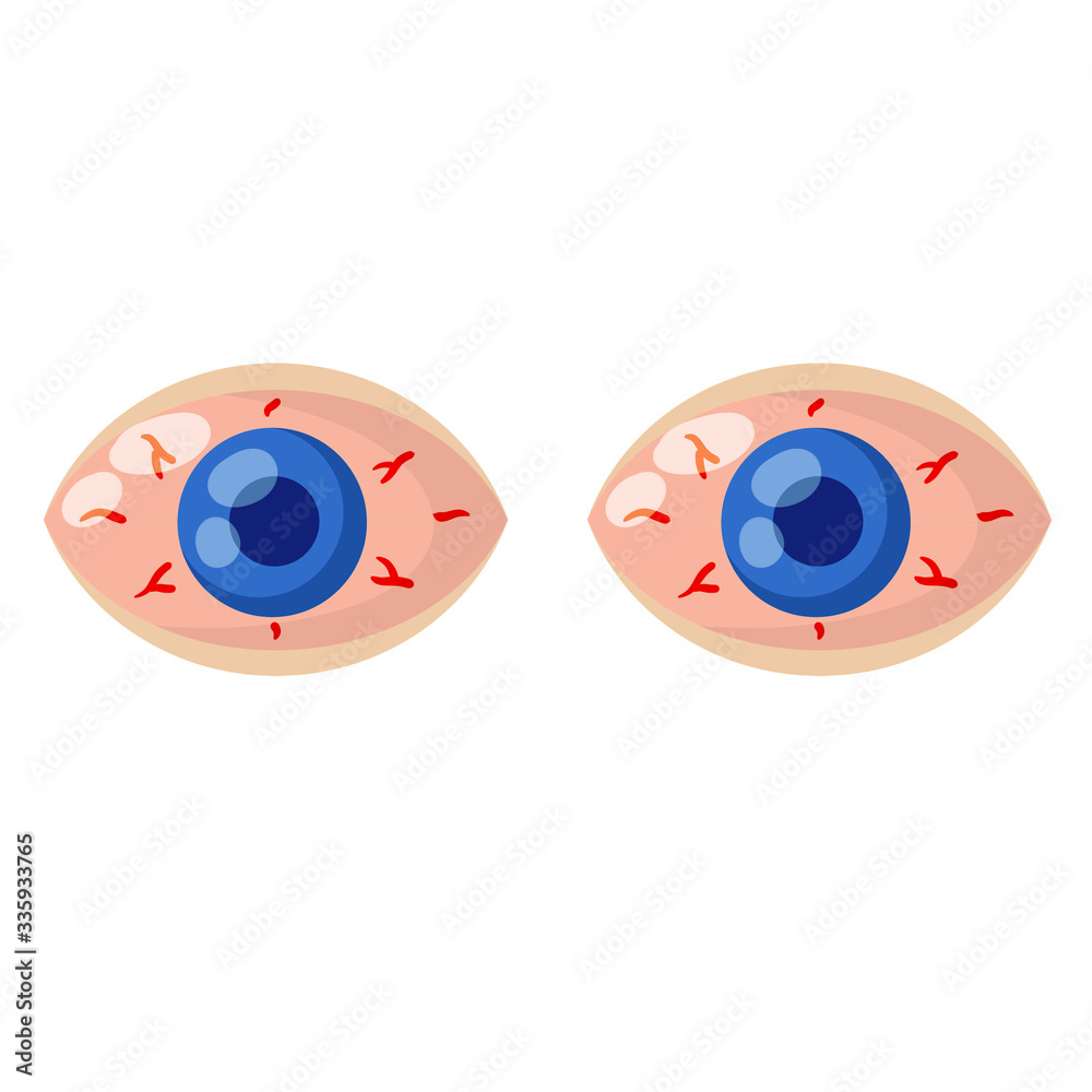 Vetor de Red eye. Eyeball disease and Allergy. Conjunctivitis and human ...