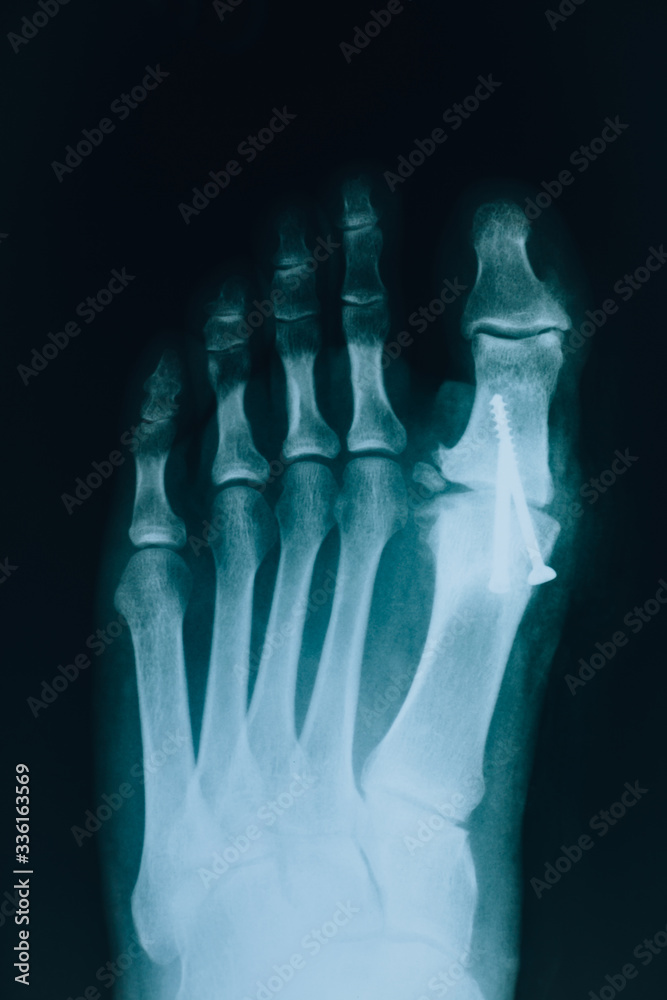 X-ray of the foot. Human foot, bones, at an appointment with a doctor ...