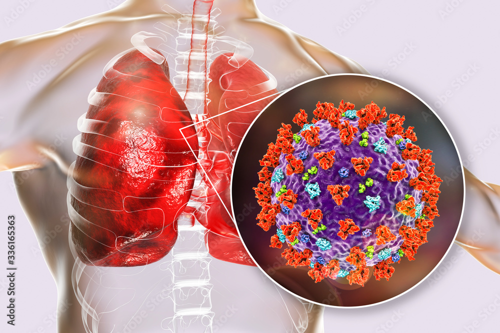 SARS-CoV-2 viruses in alveoli of human lungs causing COVID-19. Novel ...