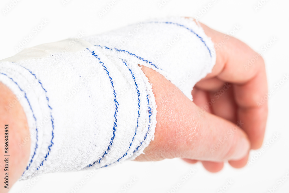 chemical burn on the wrist skin with hydroxide sodium acid. Household ...