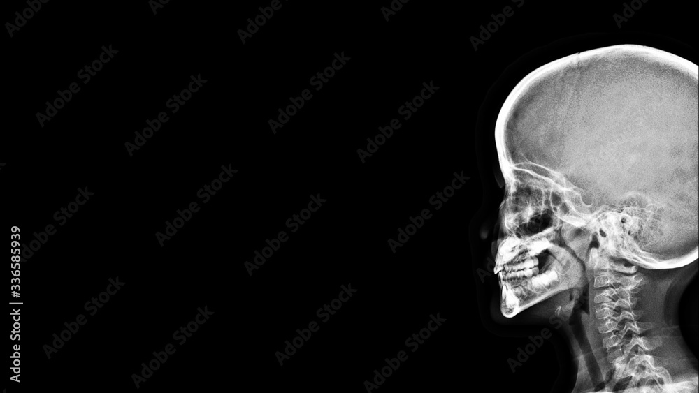 Film X Ray Skull Radiograph Show Adenoid Hypertrophy Enlarged Adenoid Cause Airway Obstruction