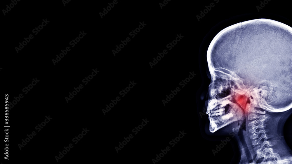 Film X-ray skull radiograph show adenoid hypertrophy. Enlarged adenoid ...