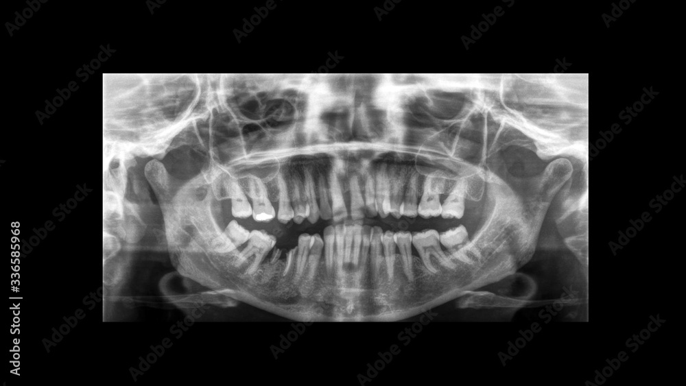 Foto de Film X ray teeth radiograph show broken tooth (enamel dentine ...