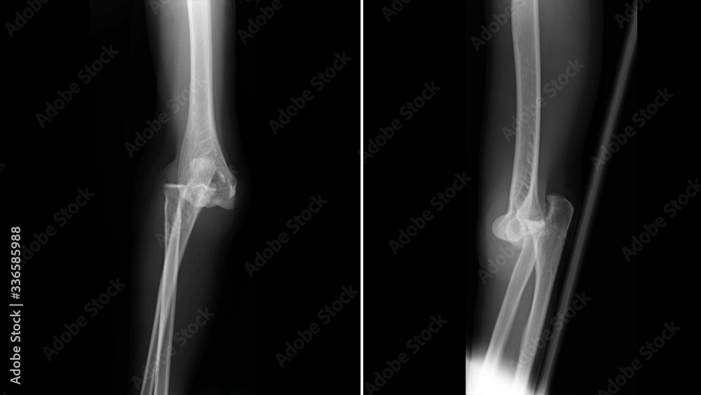 Film X ray elbow radiograph show elbow dislocation. Joint dislocation ...