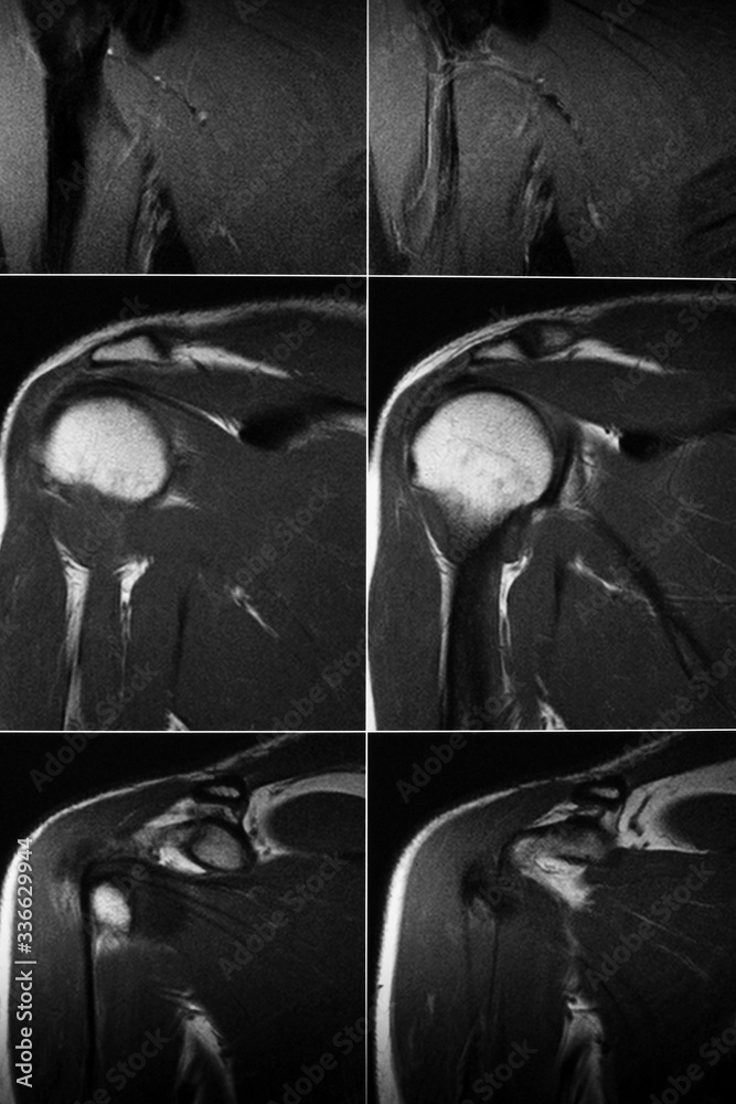 MRI scan of the shoulder joint Stock Photo | Adobe Stock