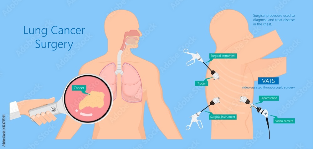 VATS lung cancer treatment sub pus tap cell open tube COPD RATS Wedge ...