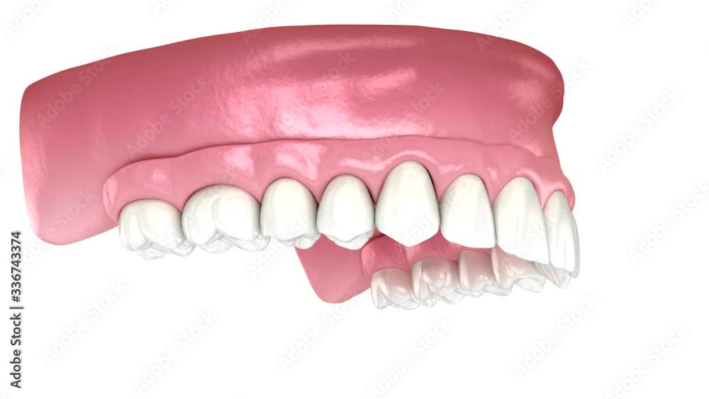 Maxillary prosthesis All on 4 system supported by implants. Medically ...