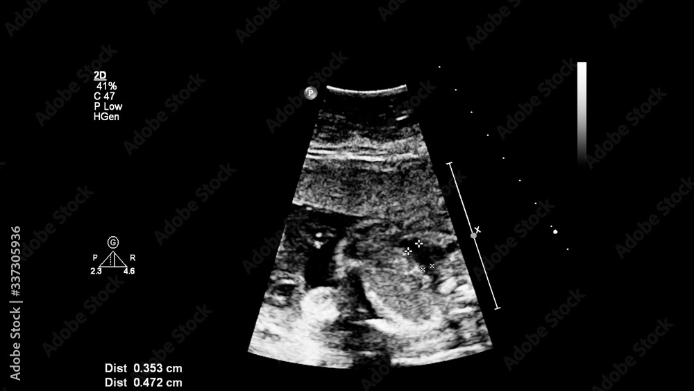 Ultrasound screen with fetal echocardiography Stock Illustration ...