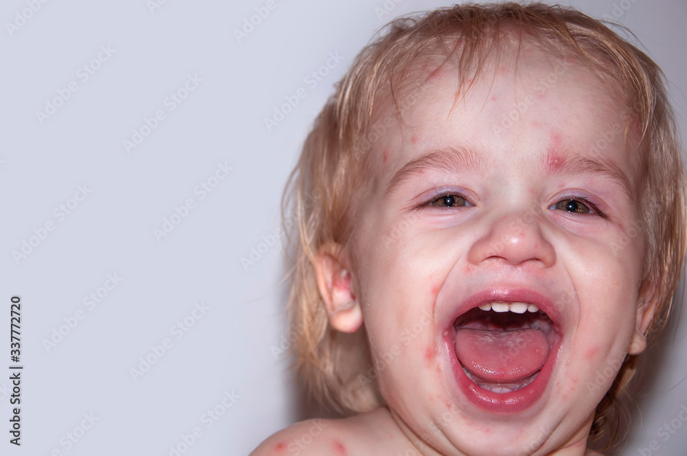 Chickenpox disease. Rash on the skin, lips, and mucous membranes of the ...