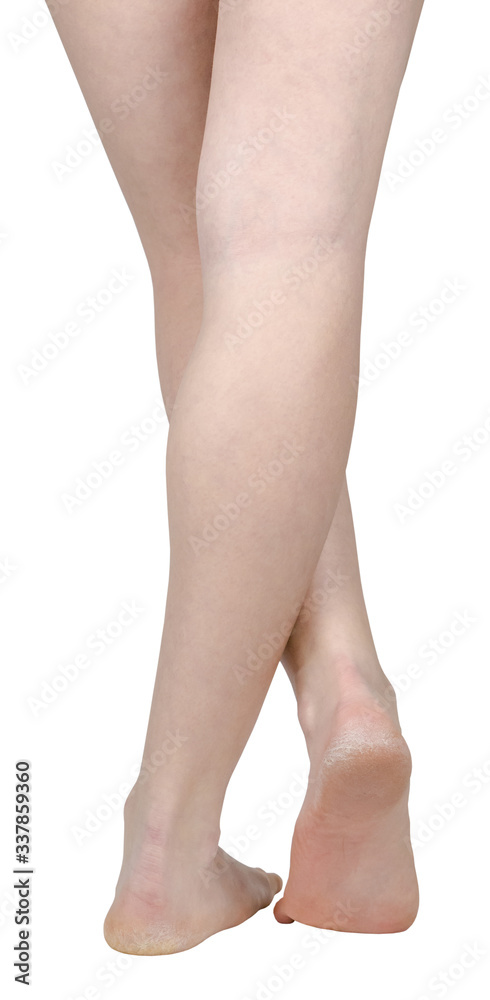 bare feet of a girl with flat feet, one foot on tiptoe, visible foot ...