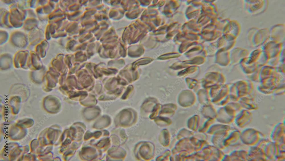 Vidéo Stock Human Blood, Diseases, Interstitial Fluid, Bacterial ...