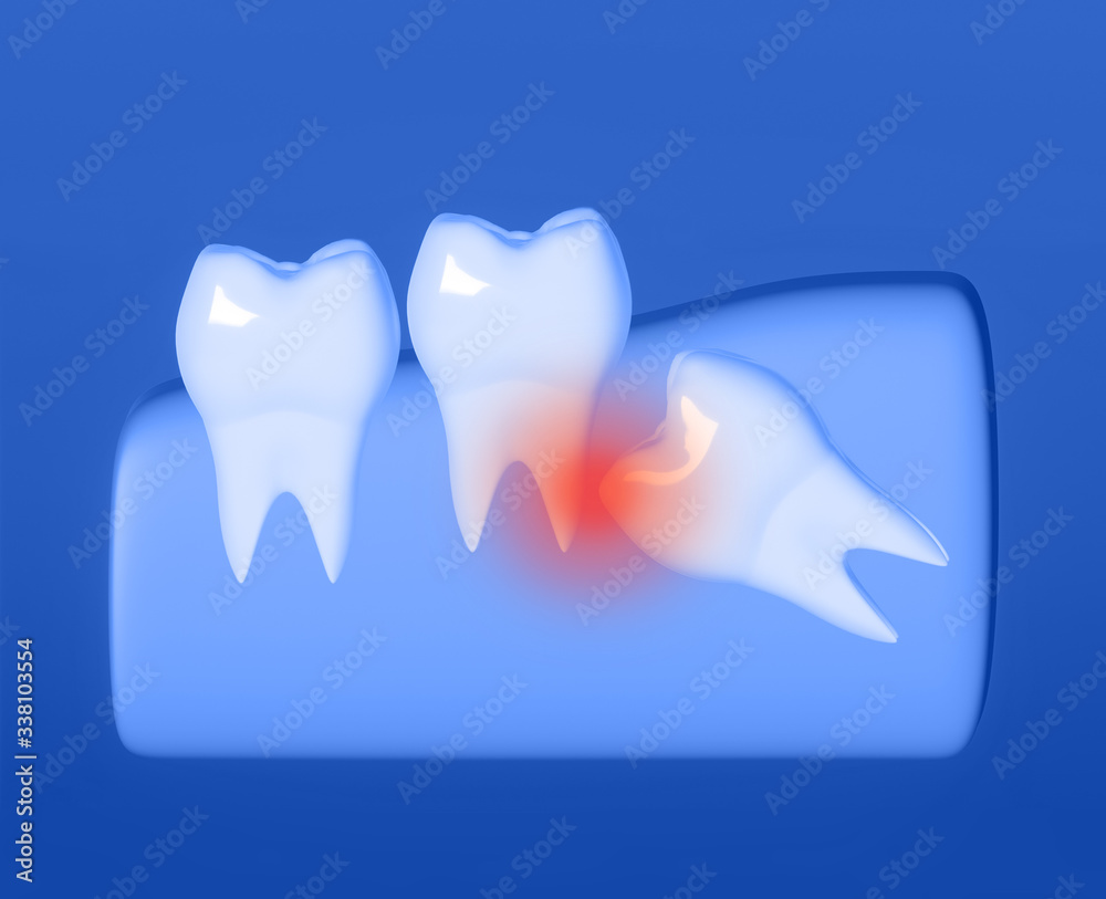 Wisdom tooth grows wrong, wisdom tooth problem, horizontal position of ...