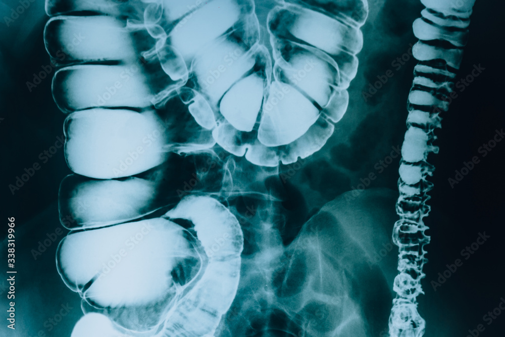 X-ray of the intestine. This x-ray is a snapshot of the internal organs ...