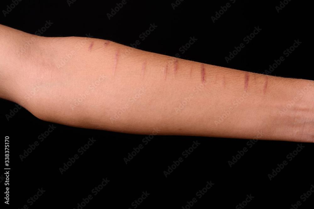 Arm of young Indian man with cuts on wrist Stock Photo | Adobe Stock