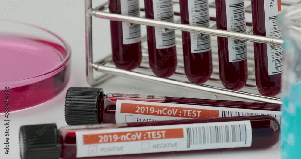 Dolly out shot of positive blood sample for COVID-19 test, laboratory ...