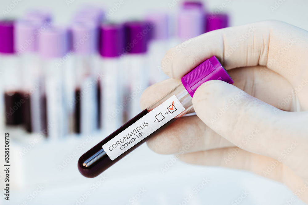 A virologist doctor is examining a sample of a blood test with ...