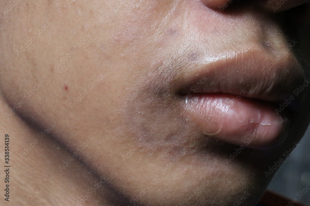 Seborrheic Dermatitis Face African American