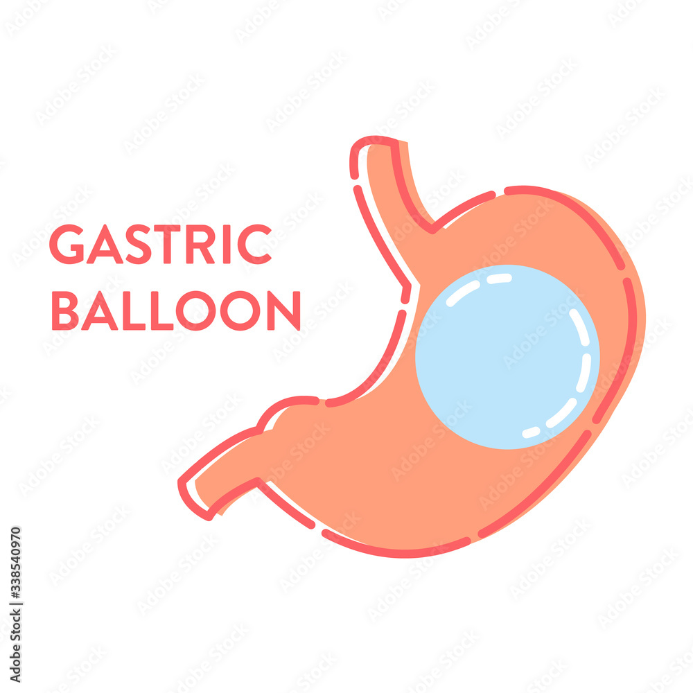 Gastric balloon non surgical weight loss procedure in stomach. Medical ...