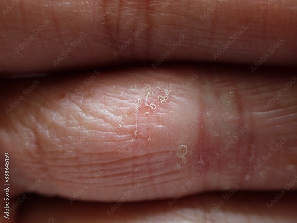 Dyshidrotic Eczema on finger close up Stock Photo | Adobe Stock